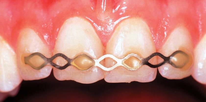 Titanium Trauma Splint 100 x 0,2 mm 1 stk - DENTALSPAR AS