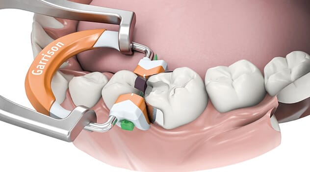 Garrison - DENTALSPAR AS